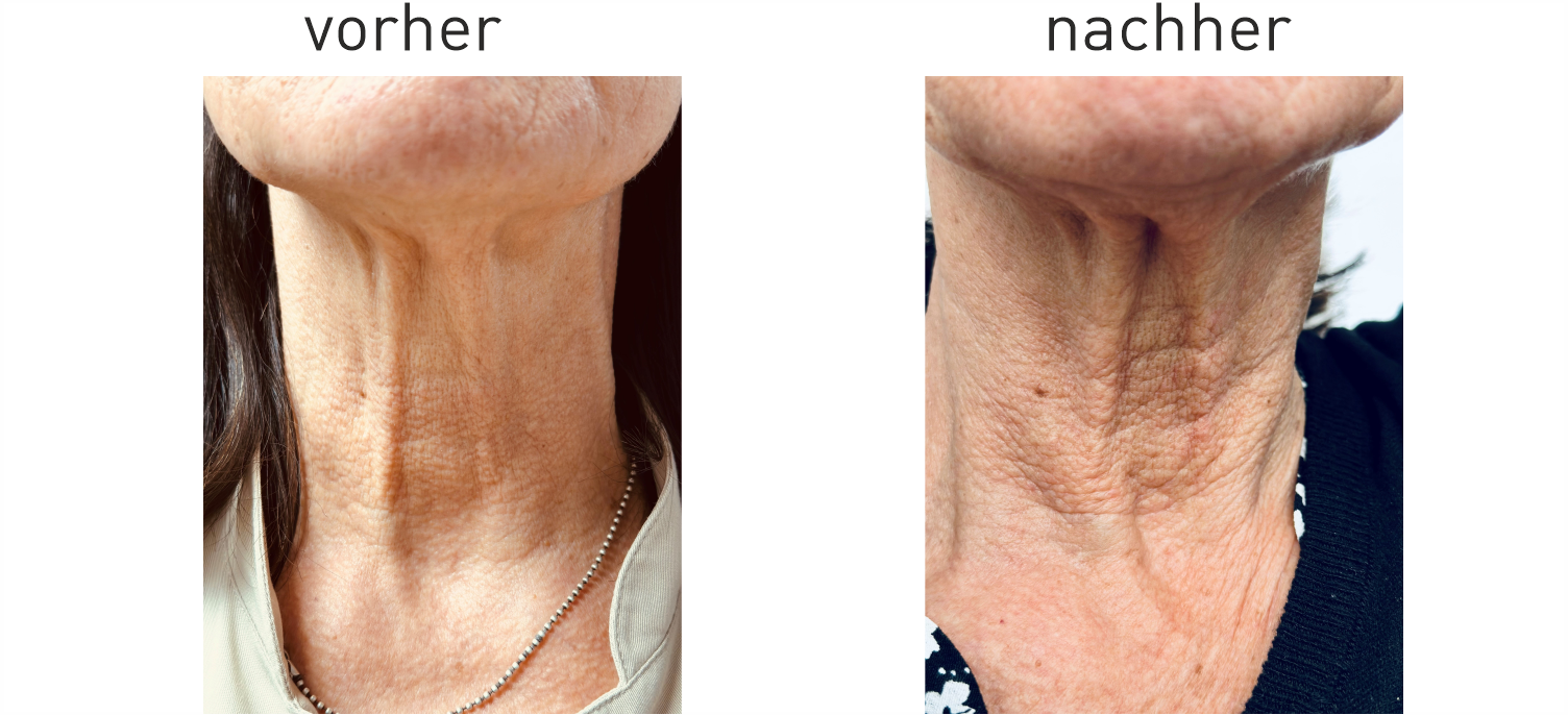 Rf Microneedling Vorher Nachher